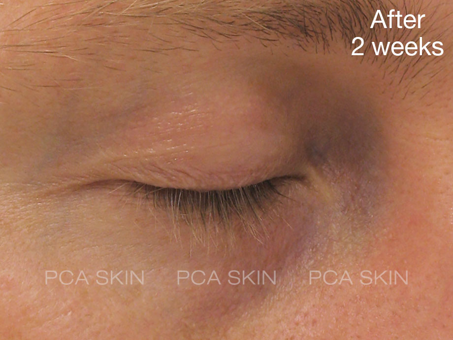 Mercer Island Dermatology | PCA Skin